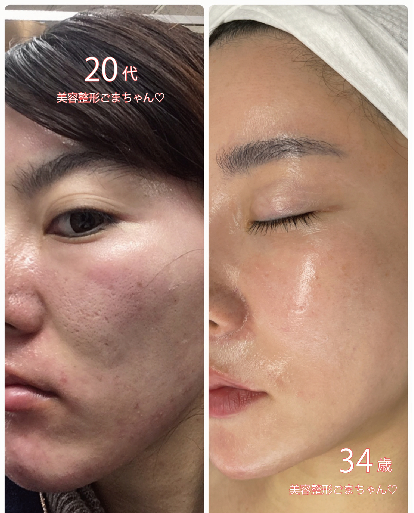 20代と今の肌(34歳)を比較してみた｜美容整形ごまちゃん｜coconalaブログ